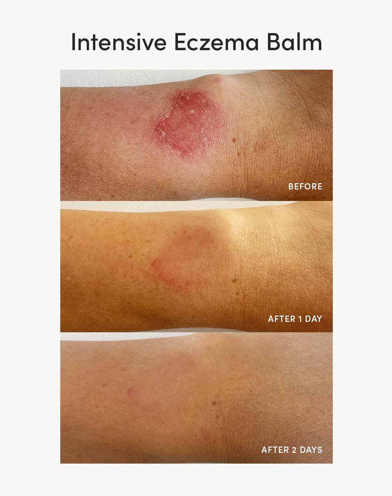 Intensive Eczema Balm | See The Results | Evereden