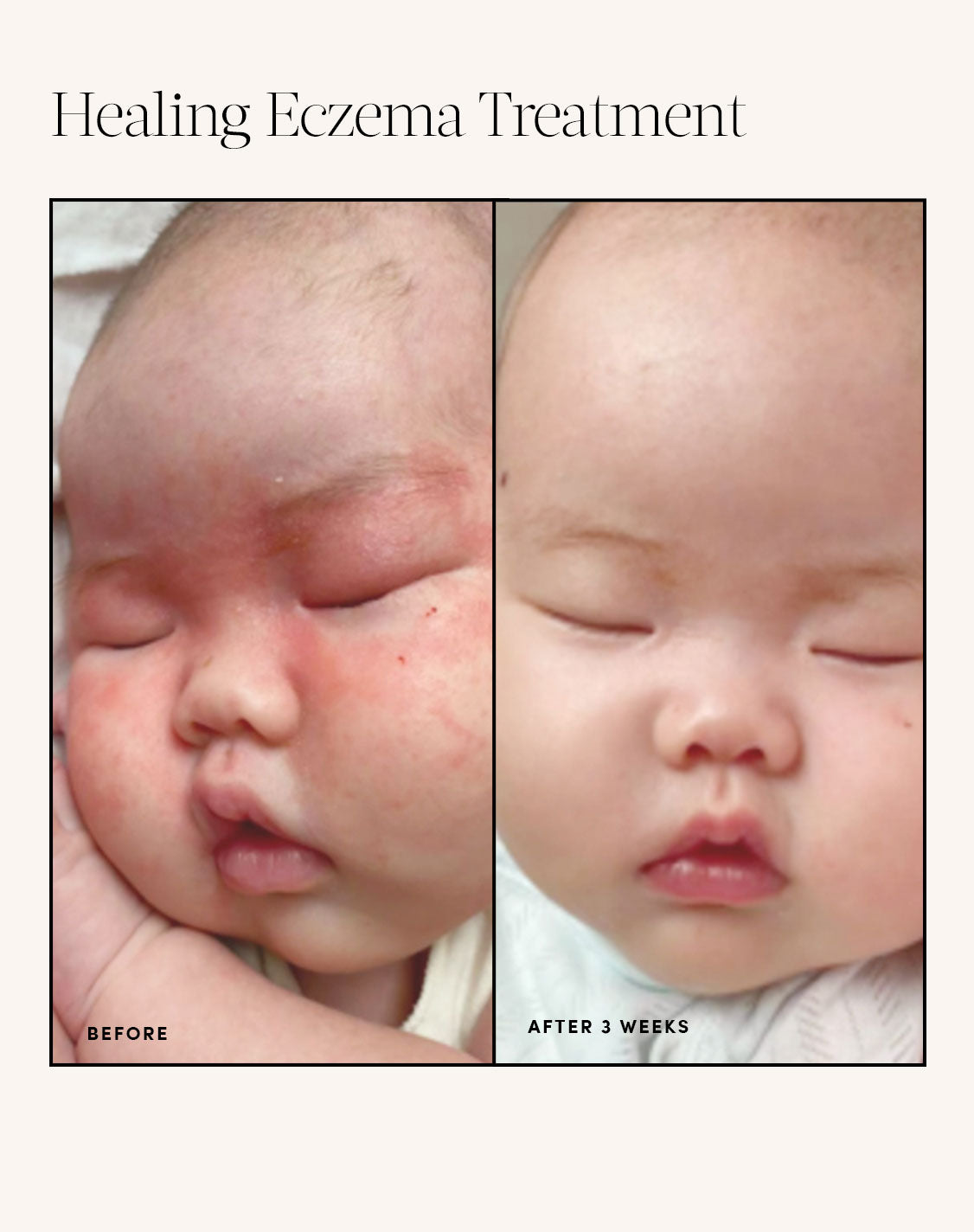 Steroid-Free Healing Eczema Treatment | See The Results | Evereden