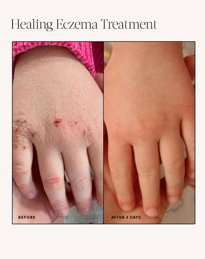 Steroid-Free Healing Eczema Treatment | See The Results | Evereden